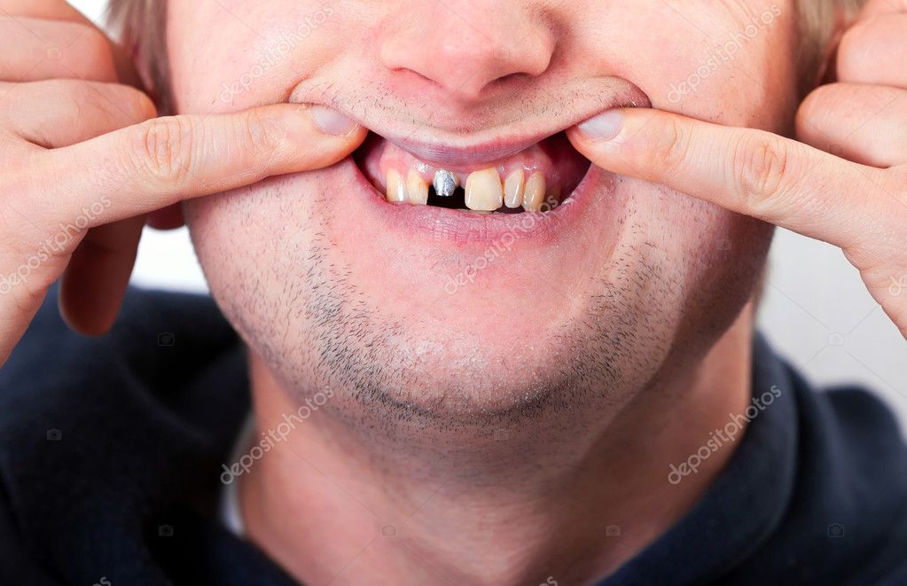 Young man face with broken tooth — Stock Photo © aragami12345 #7197740